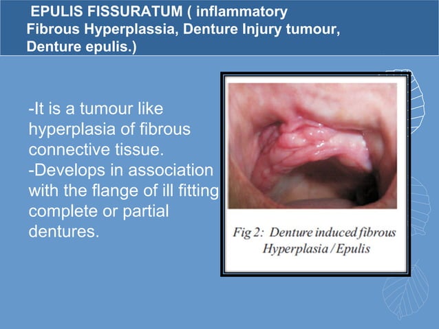 Denture induced lesions- Aarti Dubey | PPT