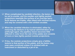 Denture induced lesions- Aarti Dubey | PPT