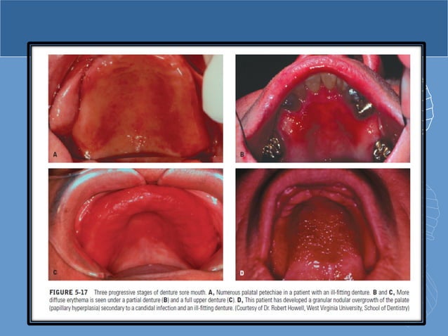 Denture induced lesions- Aarti Dubey | PPT
