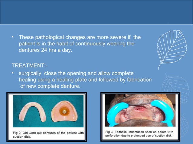 Denture induced lesions- Aarti Dubey | PPT