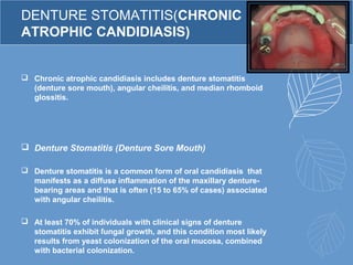 Denture Candidiasis