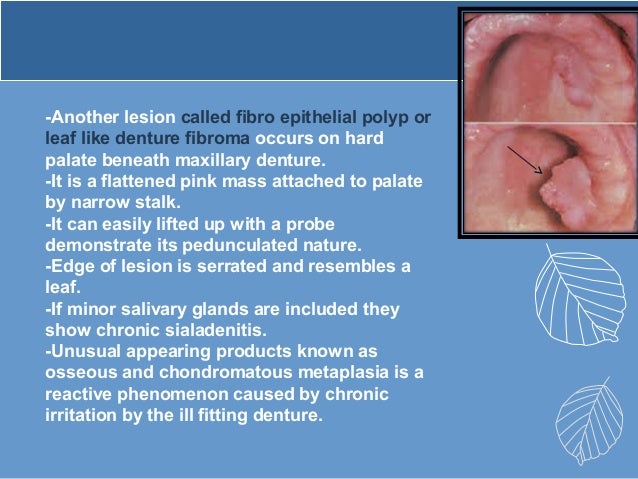 Denture induced lesions- Aarti Dubey