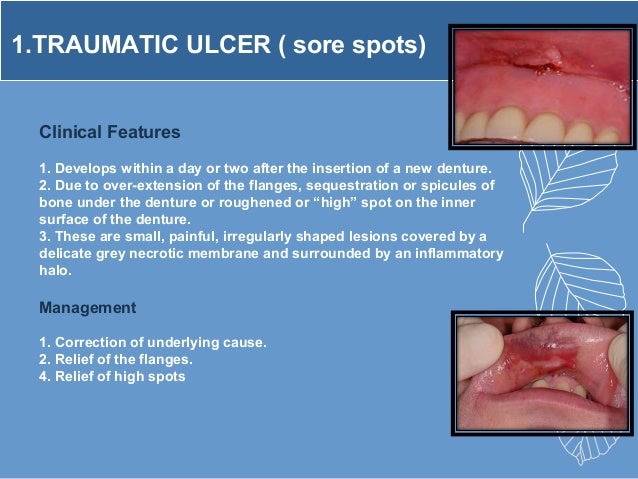 Denture induced lesions- Aarti Dubey