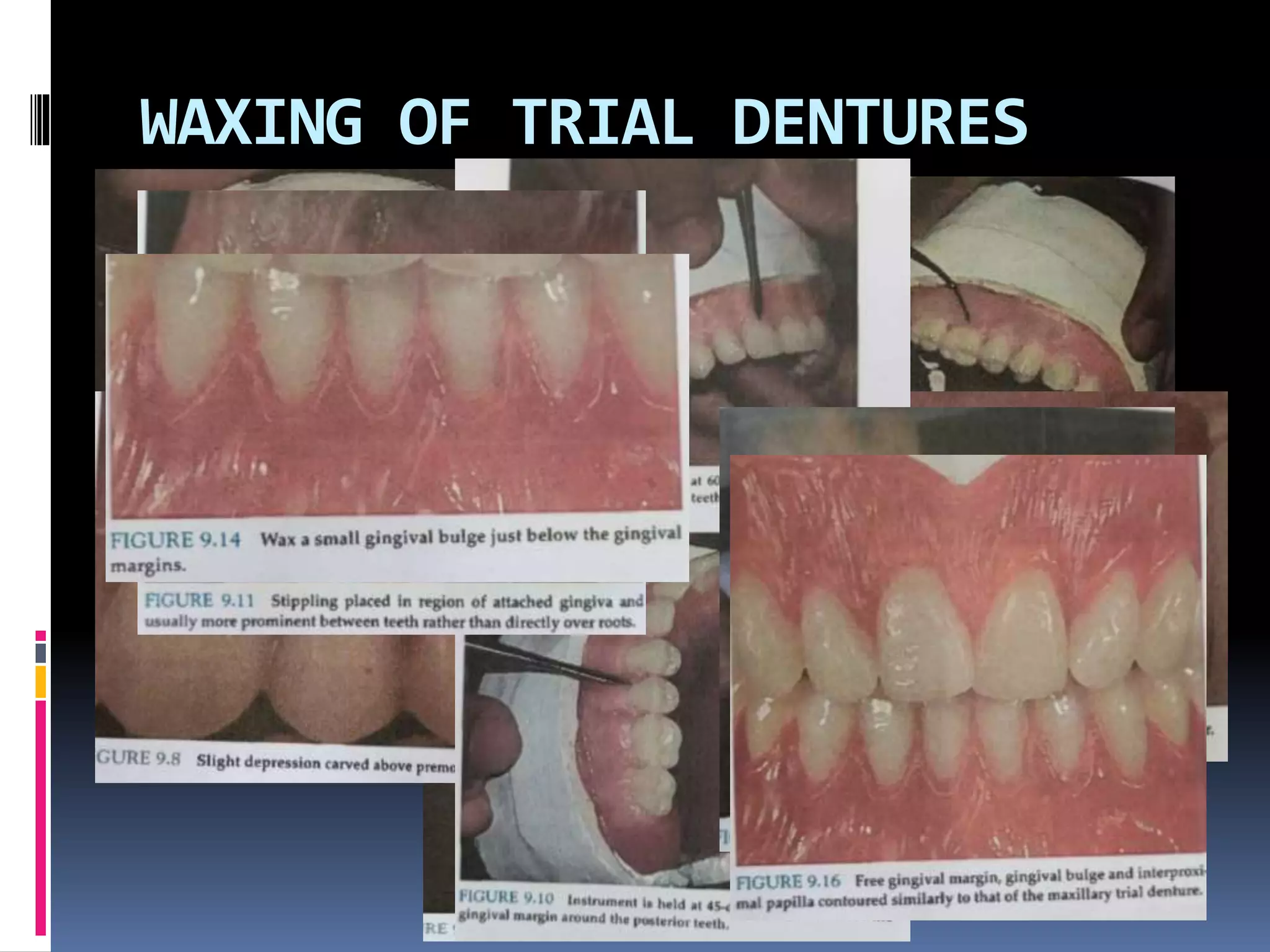 Denture processing | PPTX