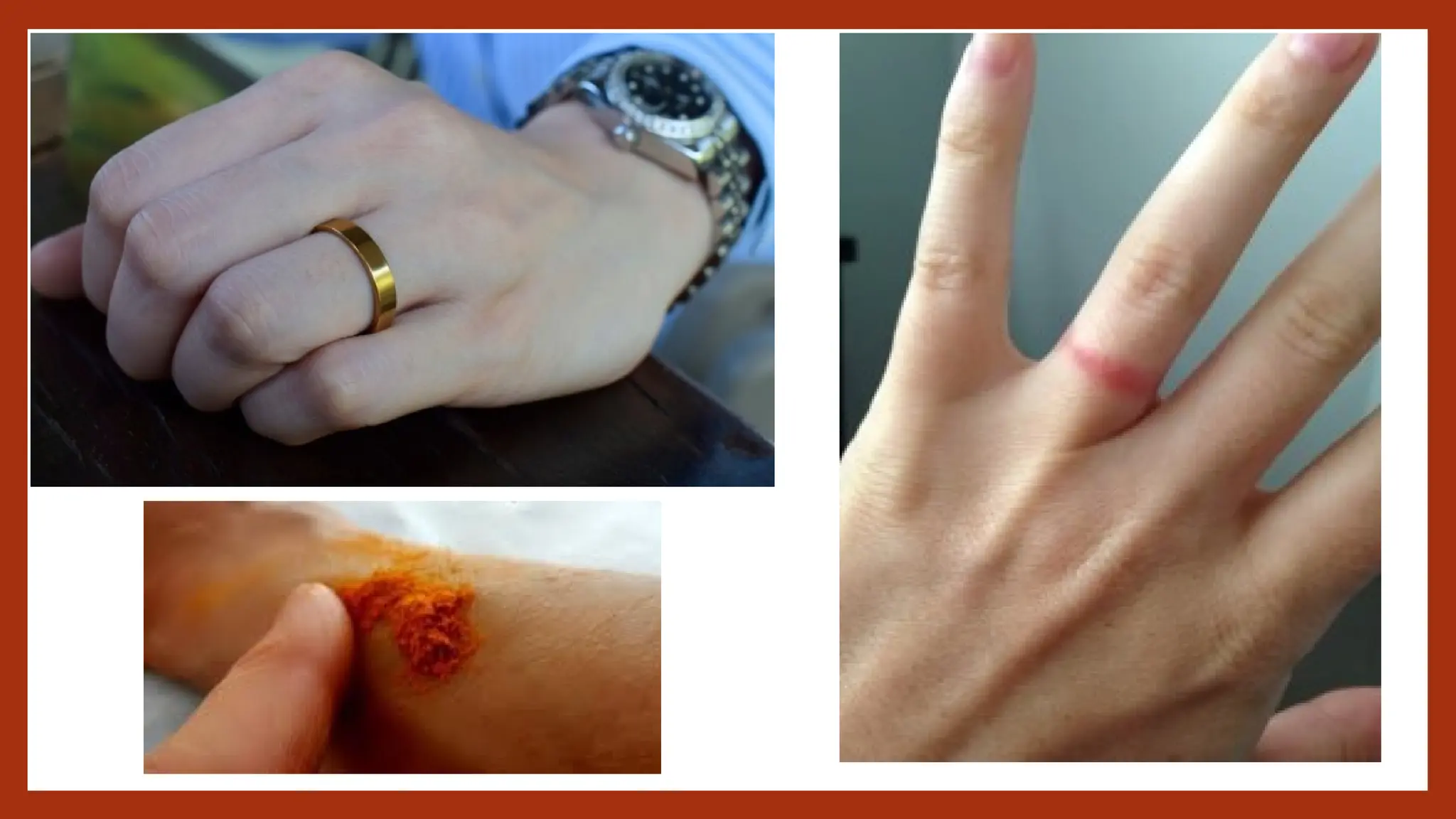 Denture Relining & Rebasing - Dental Materials | PPTX