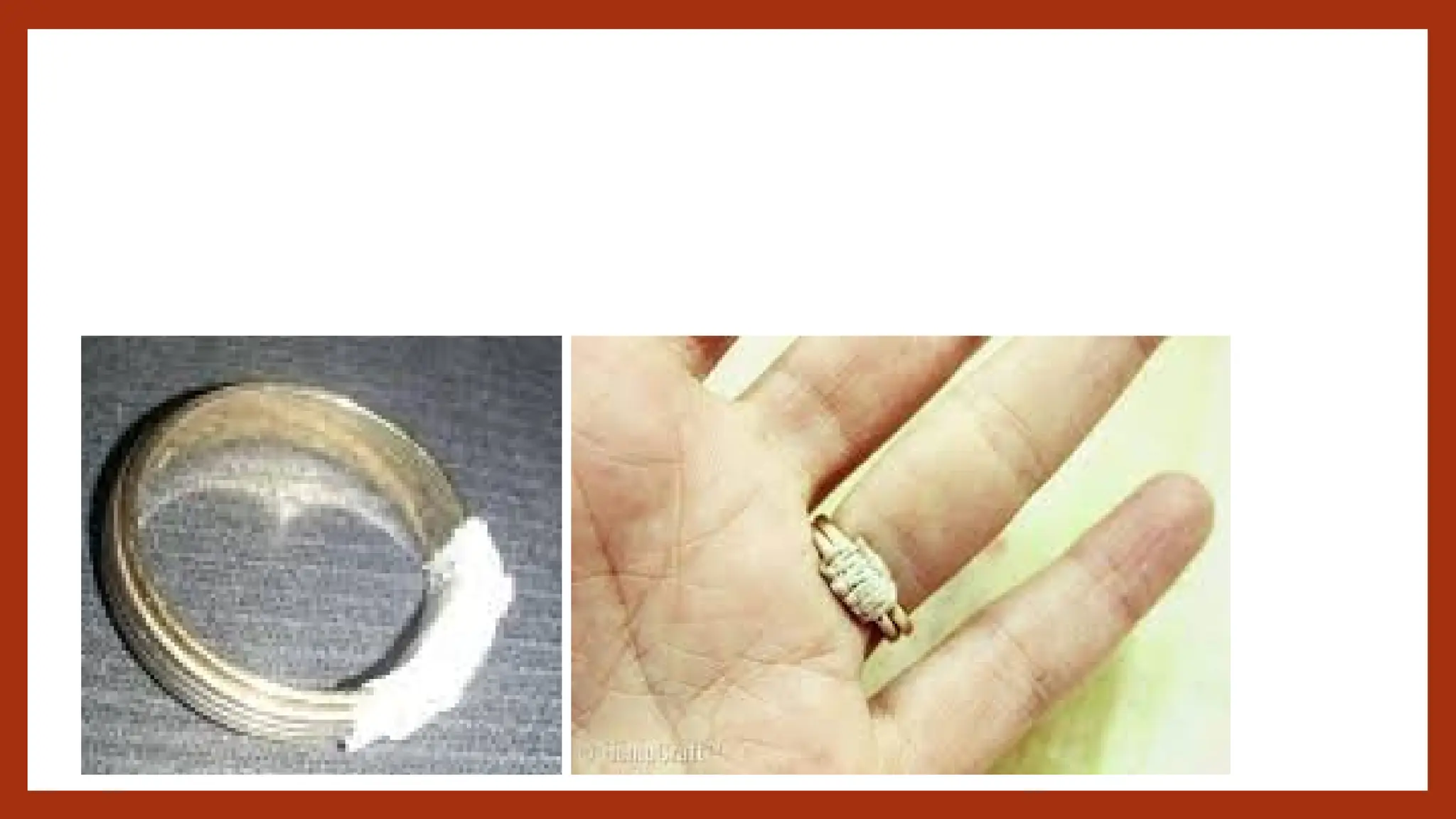 Denture Relining & Rebasing - Dental Materials | PPTX