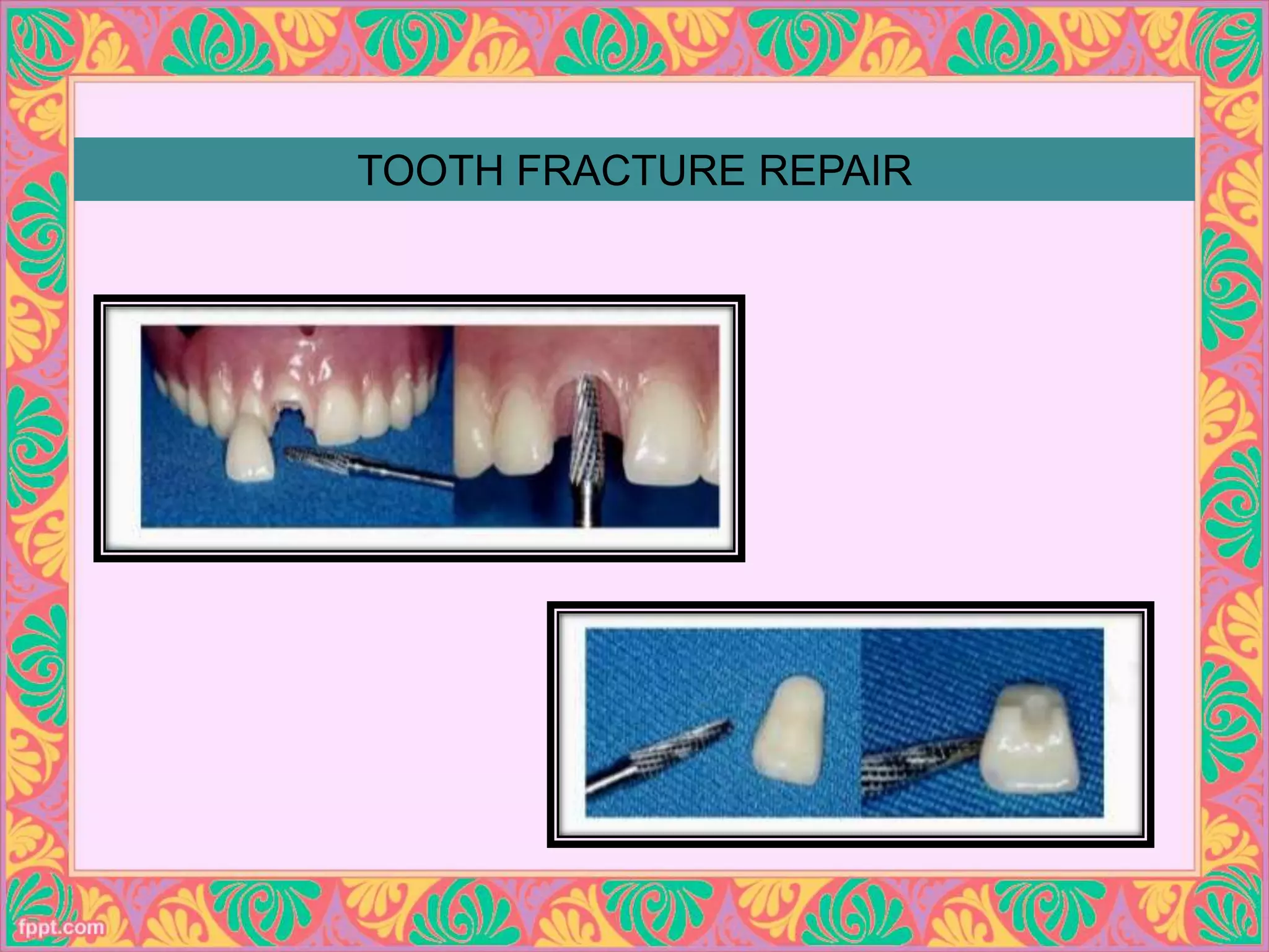 Denture Repair . | PPTX
