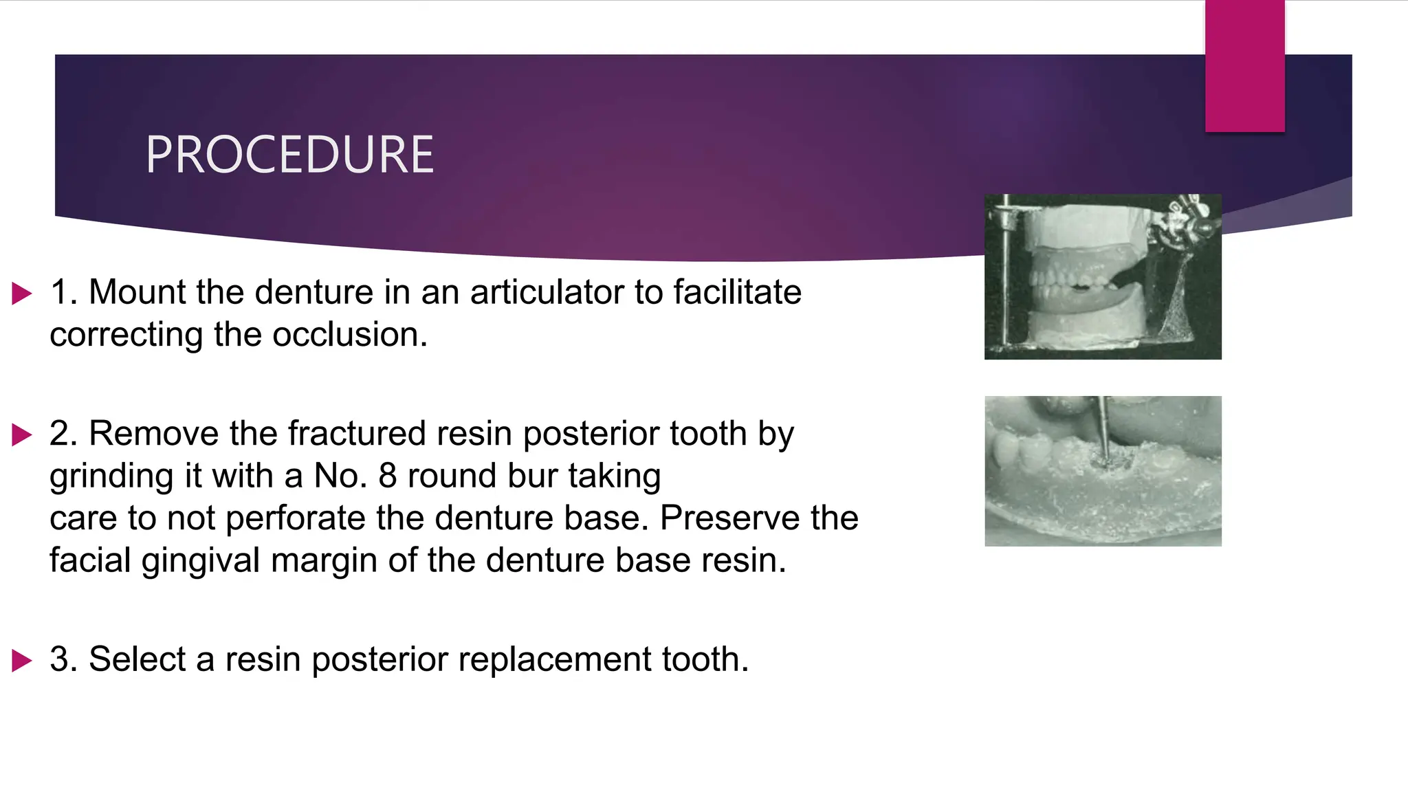 Denture repair in complete dentures .pptx