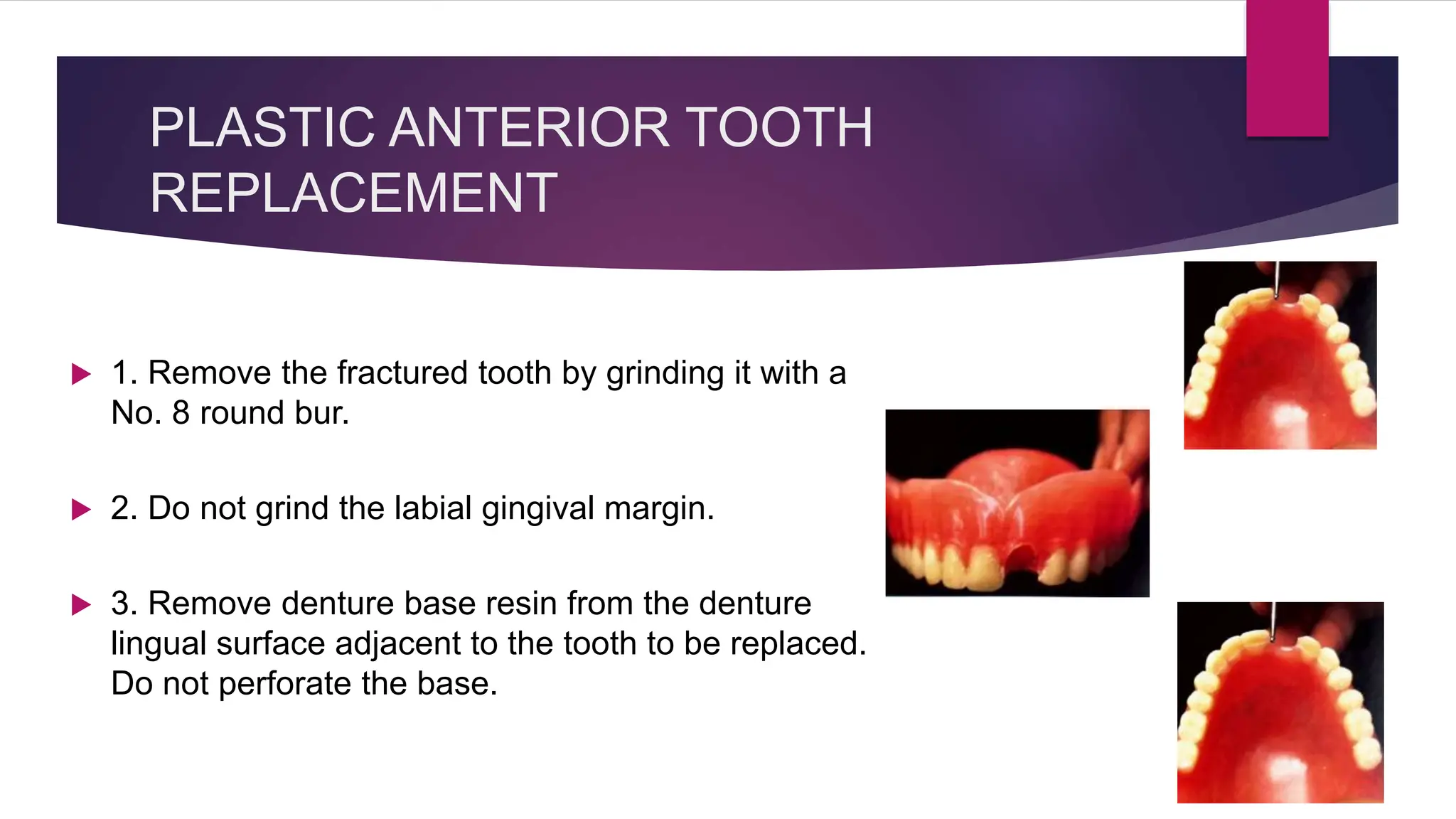 Denture repair in complete dentures .pptx