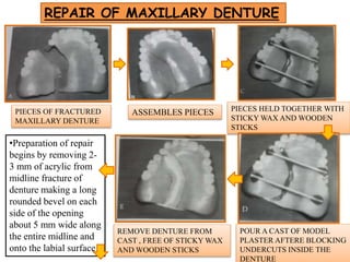 DENTURE REPAIR_112600.pptx