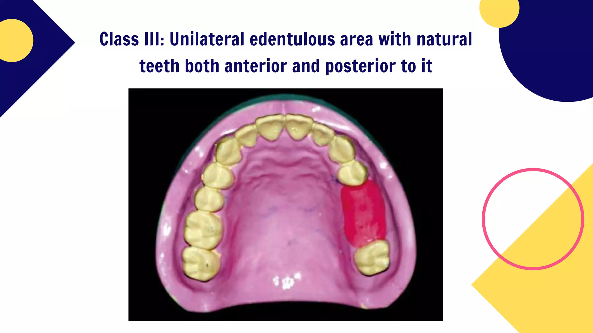 DENTURES - CLASSIFICATION OF PARTIALLY EDENTULOUS ARCHES - CLASPS.pdf ...
