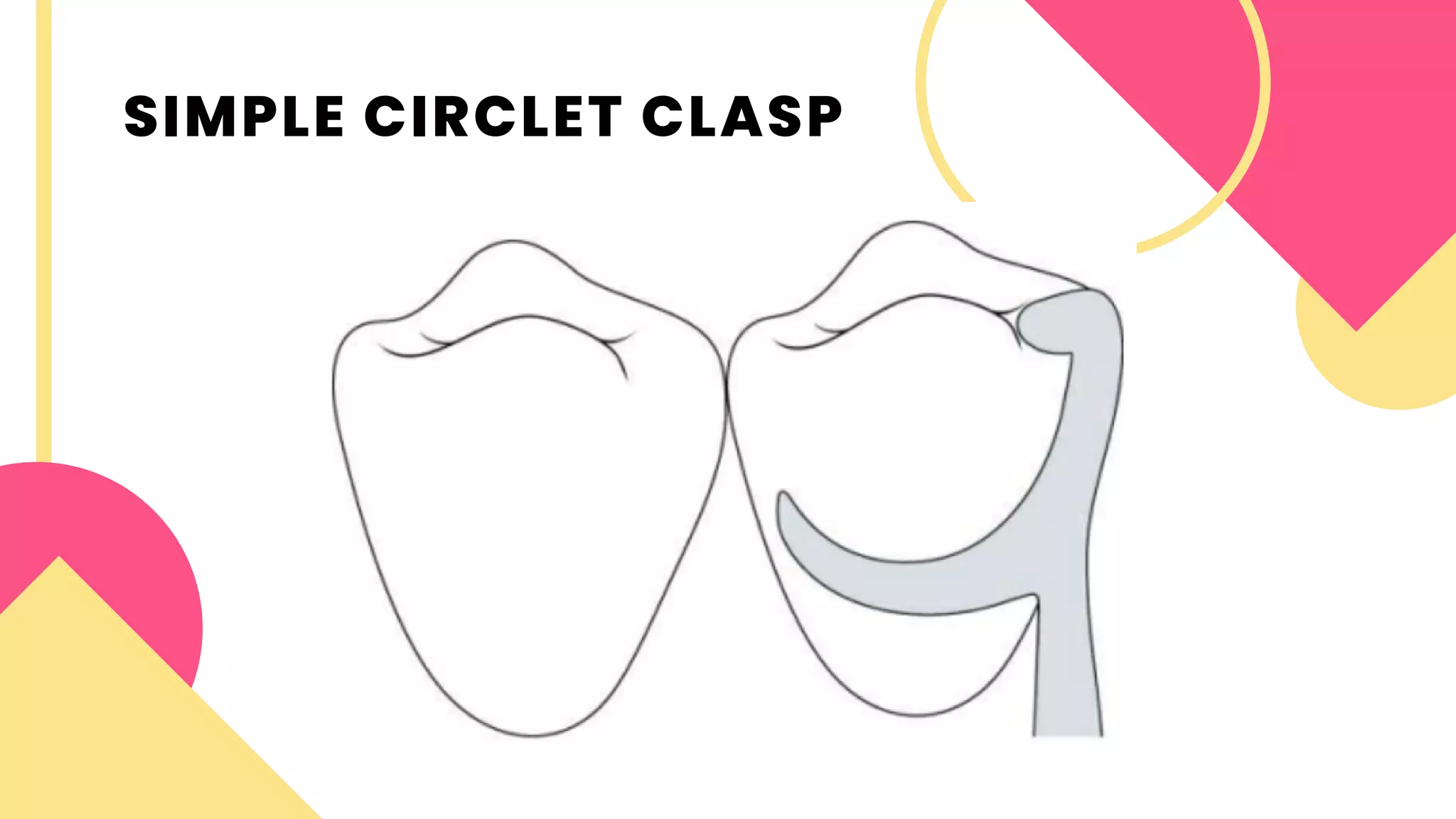DENTURES - CLASSIFICATION OF PARTIALLY EDENTULOUS ARCHES - CLASPS.pdf ...