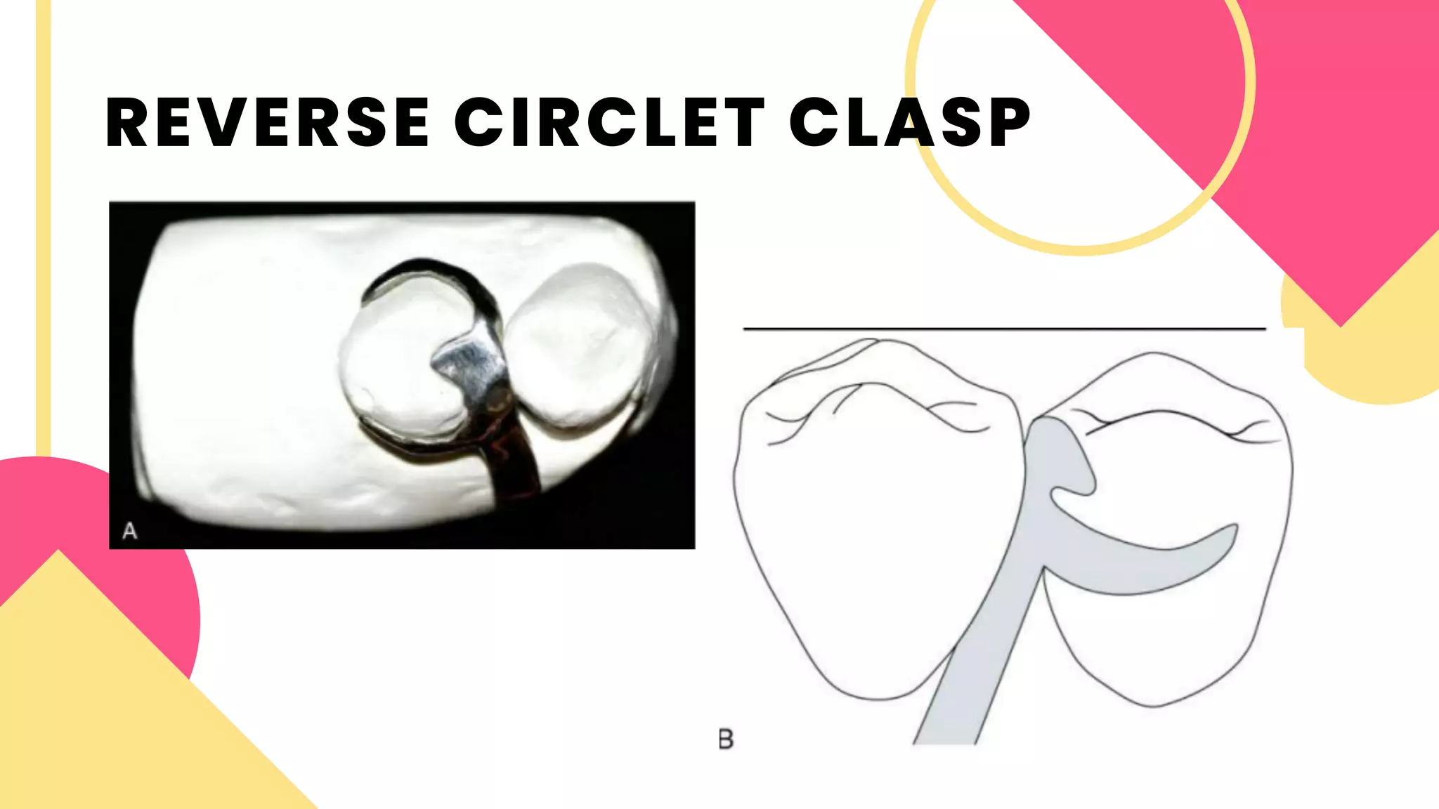 DENTURES - CLASSIFICATION OF PARTIALLY EDENTULOUS ARCHES - CLASPS.pdf ...