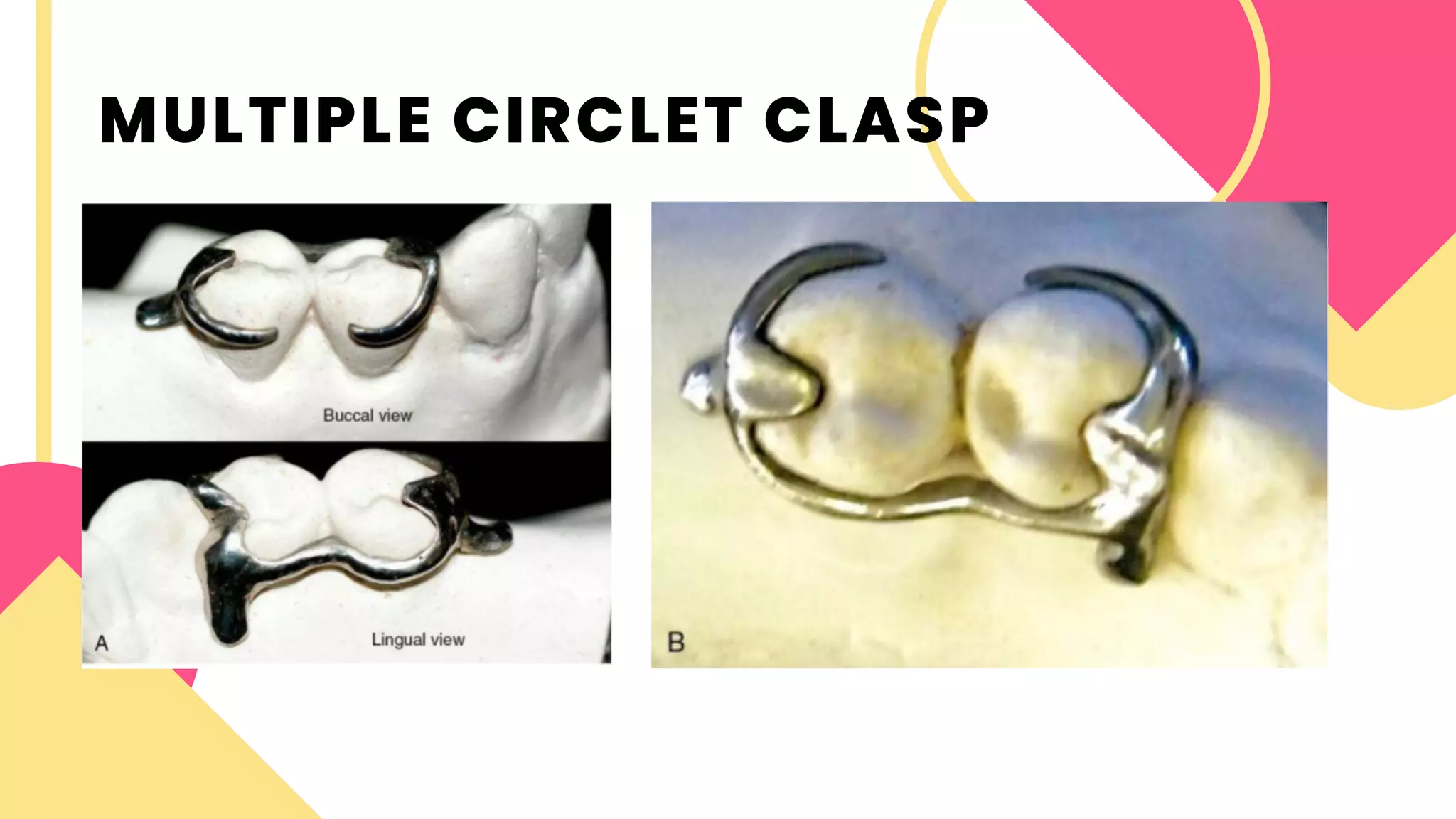 DENTURES - CLASSIFICATION OF PARTIALLY EDENTULOUS ARCHES - CLASPS.pdf ...