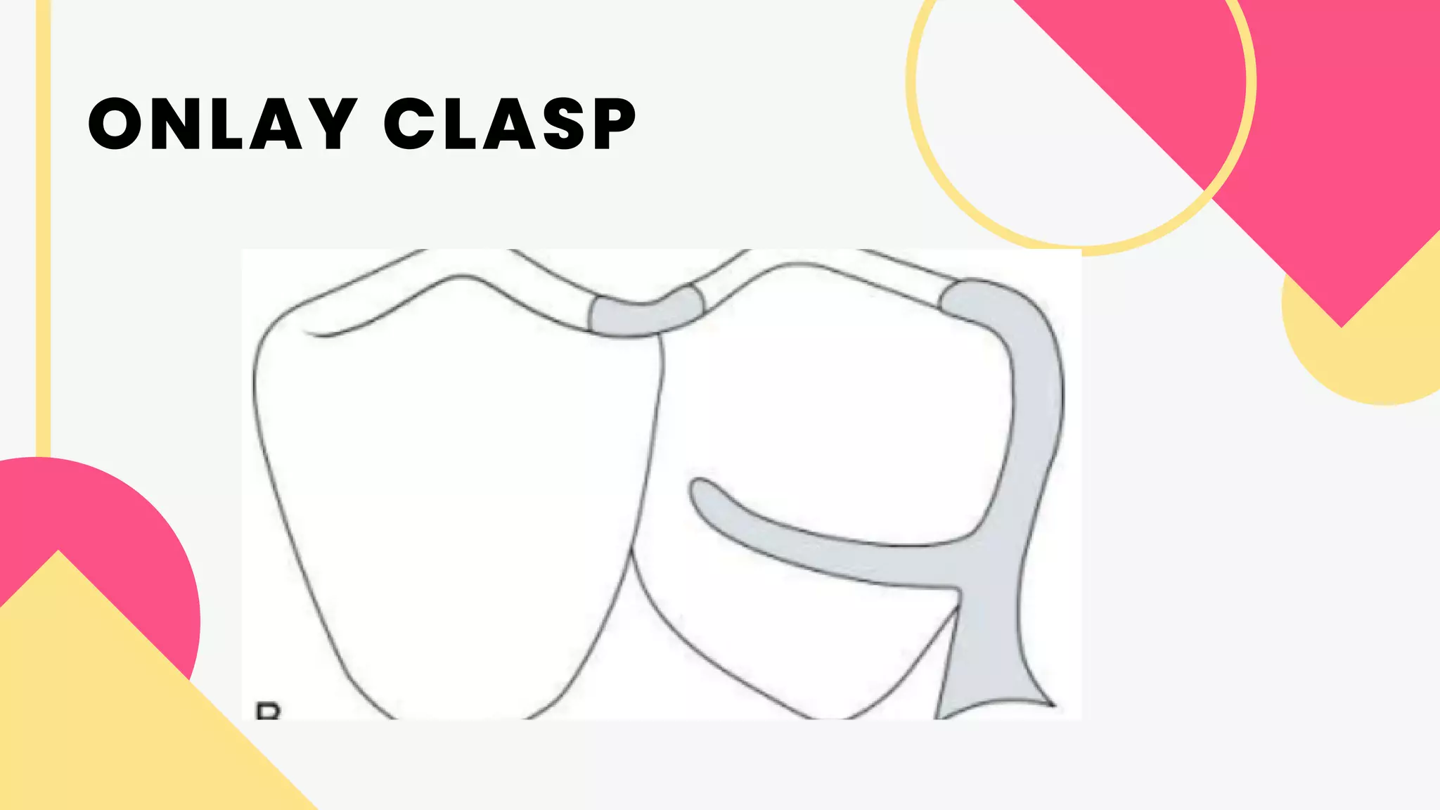 DENTURES - CLASSIFICATION OF PARTIALLY EDENTULOUS ARCHES - CLASPS.pdf ...
