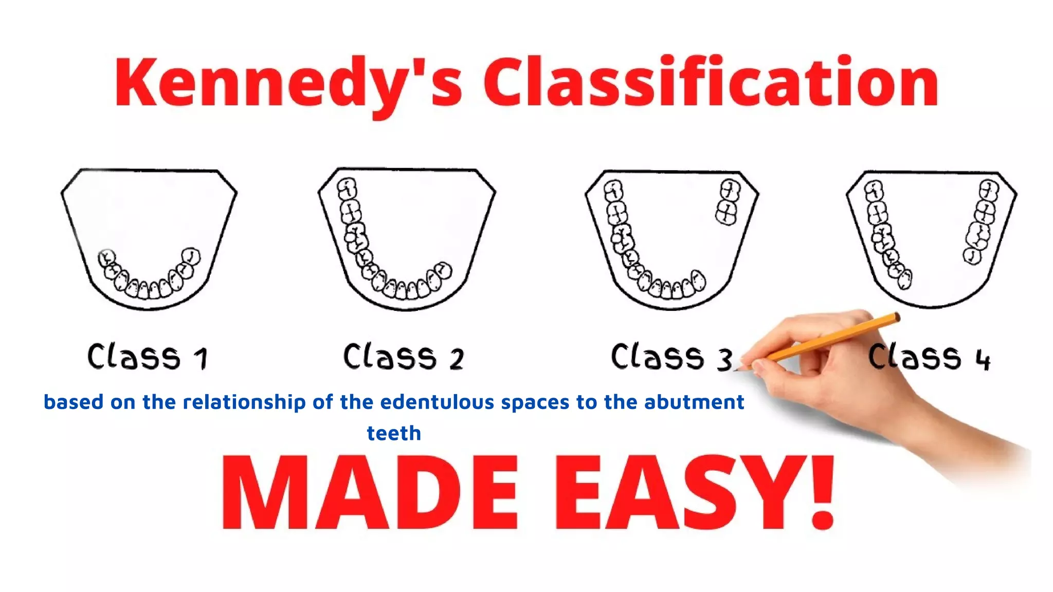DENTURES - CLASSIFICATION OF PARTIALLY EDENTULOUS ARCHES - CLASPS.pdf ...