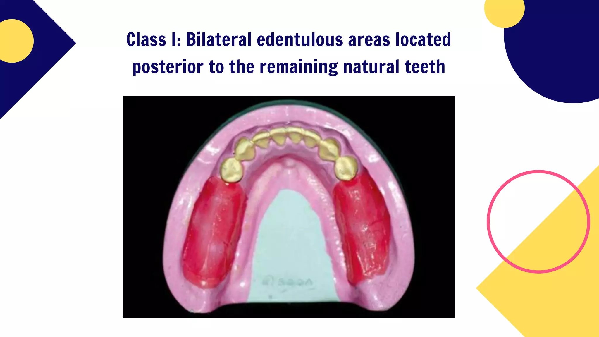 DENTURES - CLASSIFICATION OF PARTIALLY EDENTULOUS ARCHES - CLASPS.pdf ...