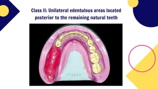 DENTURES - CLASSIFICATION OF PARTIALLY EDENTULOUS ARCHES - CLASPS.pdf