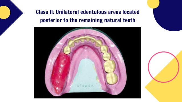 DENTURES - CLASSIFICATION OF PARTIALLY EDENTULOUS ARCHES - CLASPS.pdf ...