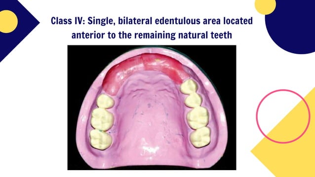 DENTURES - CLASSIFICATION OF PARTIALLY EDENTULOUS ARCHES - CLASPS.pdf ...