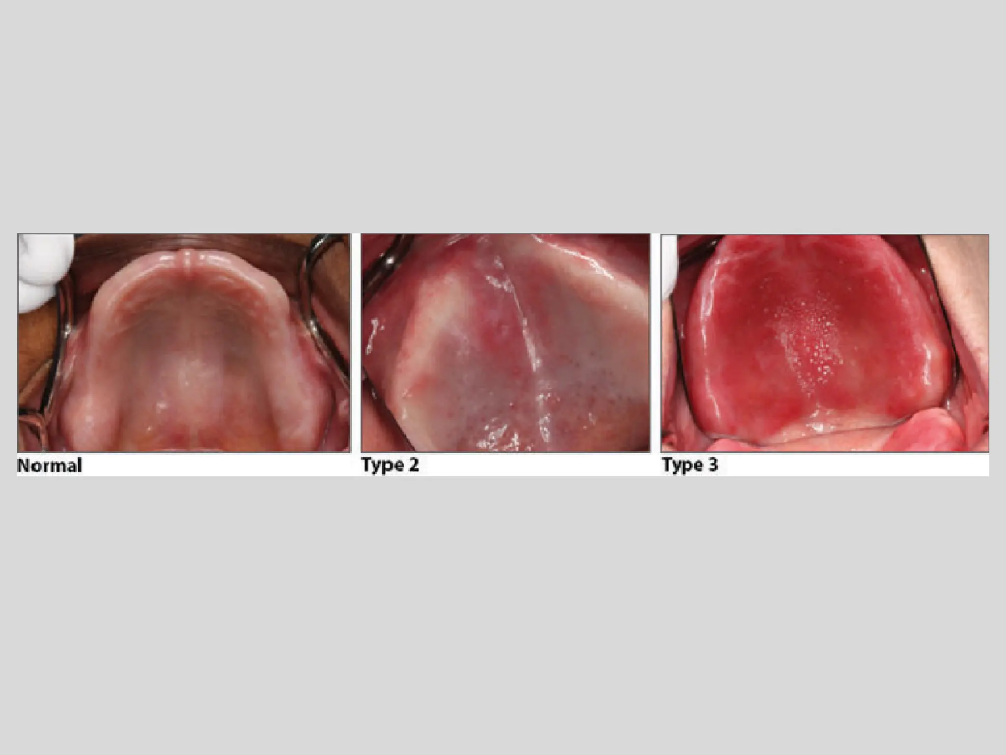 Removable prosthodontics - denture stomatitis.pdf