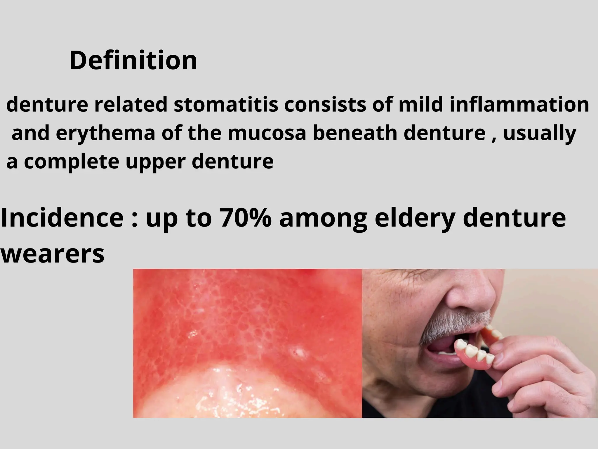 Removable prosthodontics - denture stomatitis.pdf