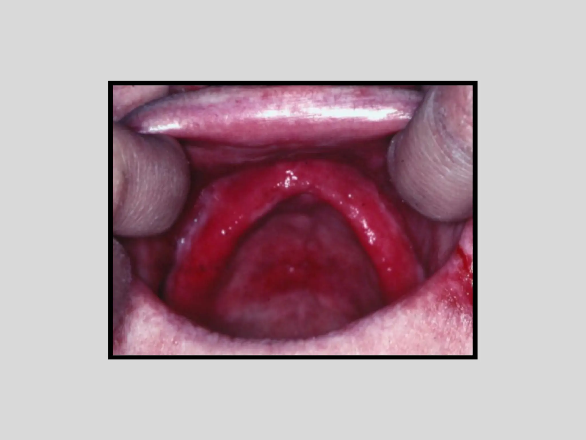 Removable prosthodontics - denture stomatitis.pdf