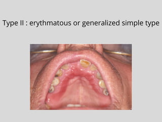 Removable prosthodontics - denture stomatitis.pdf