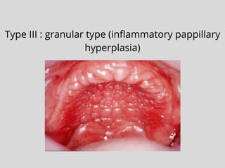 Removable prosthodontics - denture stomatitis.pdf