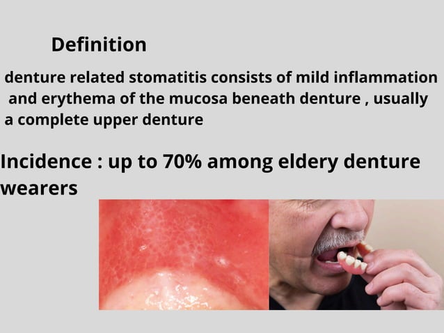 Removable prosthodontics - denture stomatitis.pdf