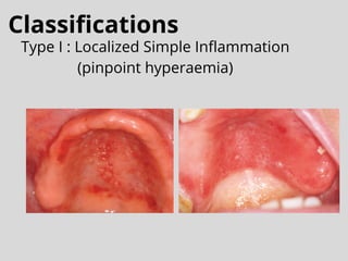 Removable prosthodontics - denture stomatitis.pdf