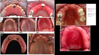 denture stomatitis jilni new complete.pptx