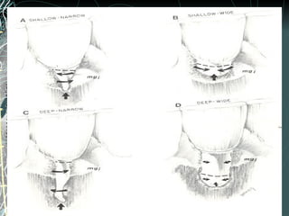Denuded root coverage /certified fixed orthodontic courses by Indian ...