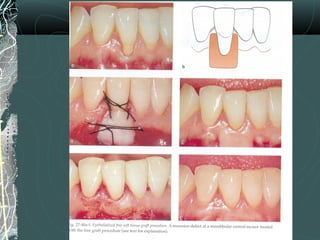 Denuded root coverage | PPT