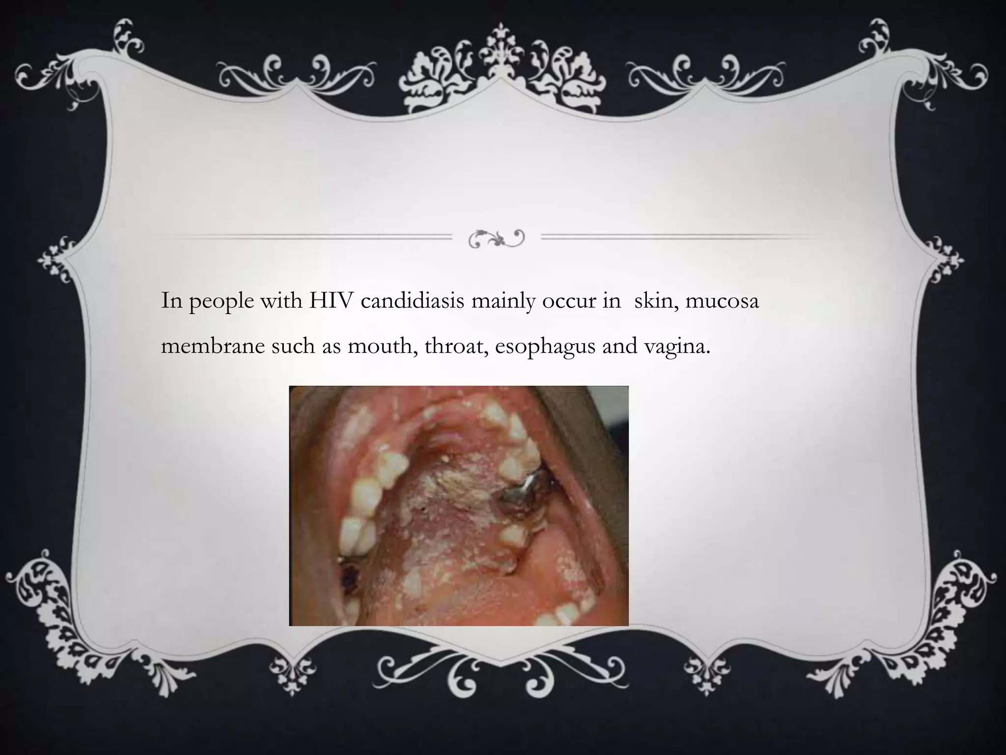 Candidiasis IN Aids | PPTX