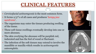 Actinomycosis, Tetanus, Syphilis.pptx