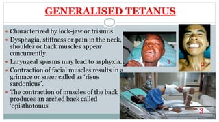 Actinomycosis, Tetanus, Syphilis.pptx