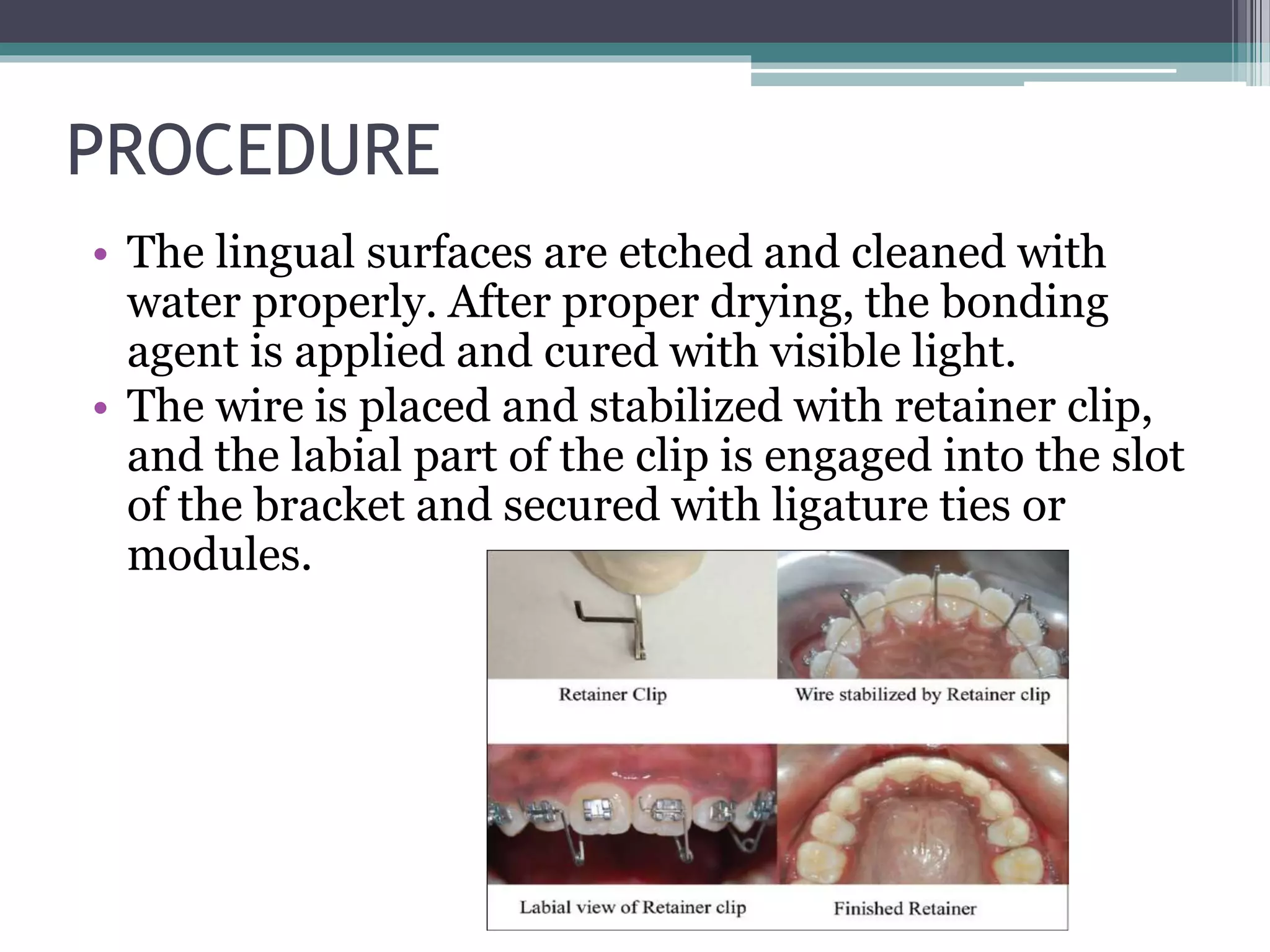 retainer clip | PPTX