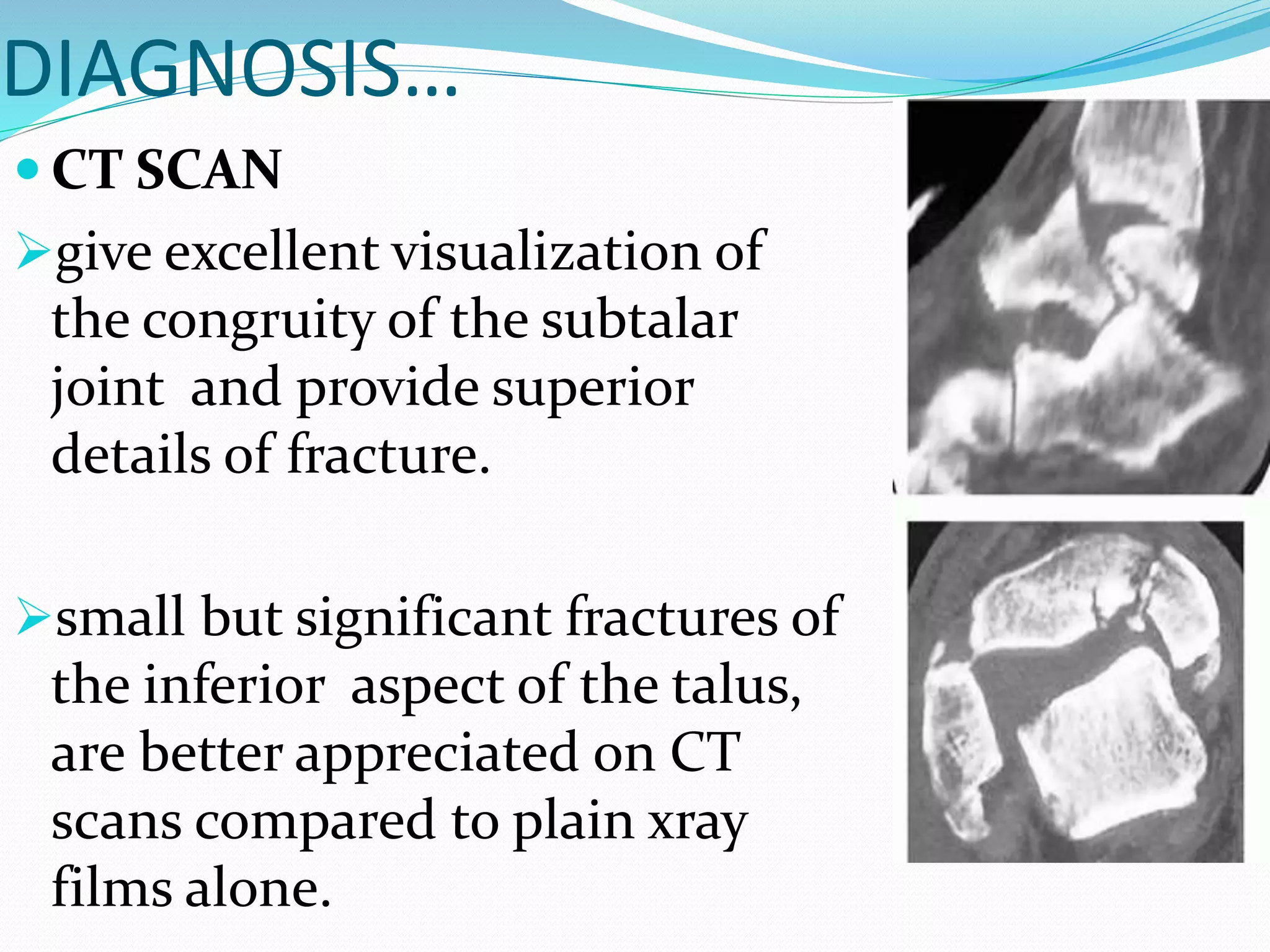 talus fracture | PPTX