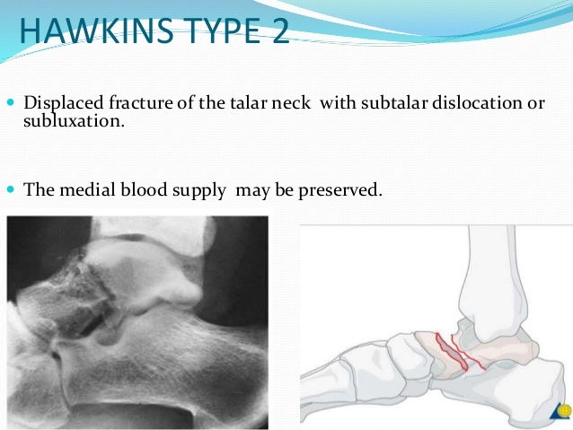 Talus Fracture Classification