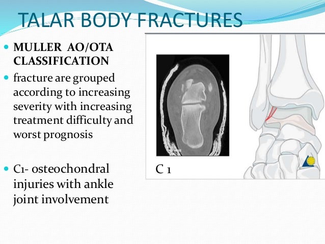 Talus Fracture Classification