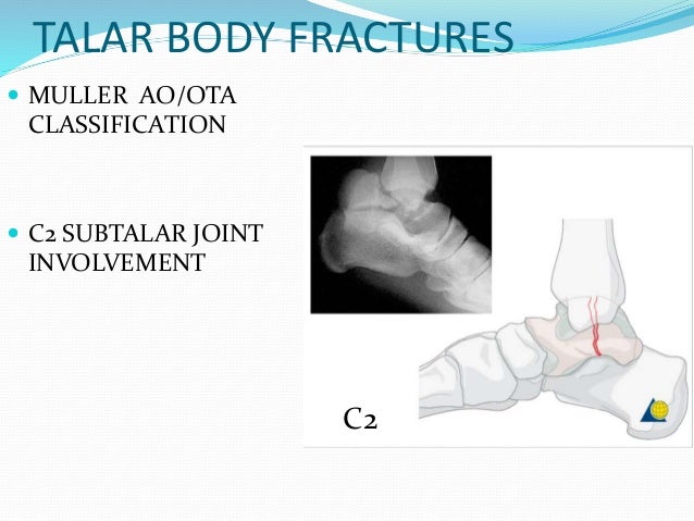 Talus Fracture Classification