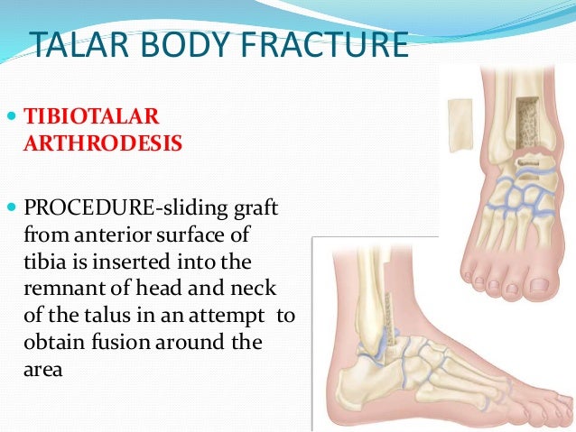 talus fracture