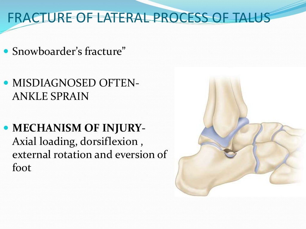 talus fracture