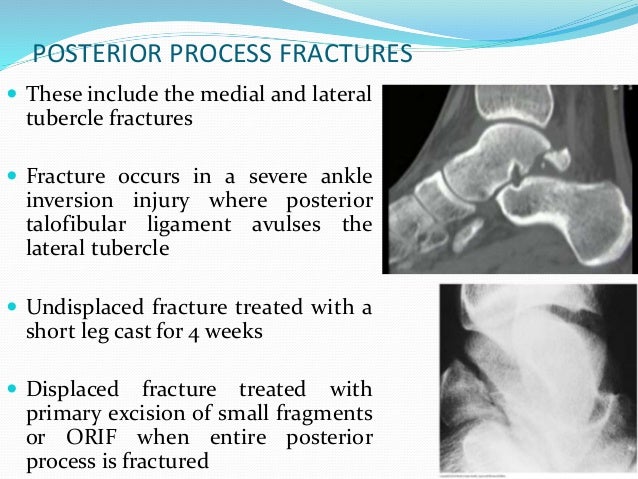 talus fracture
