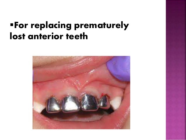 Stainless Steel Crown