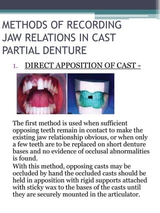 JAW RELATIONS IN CAST PARTIAL DENTURE | PPTX
