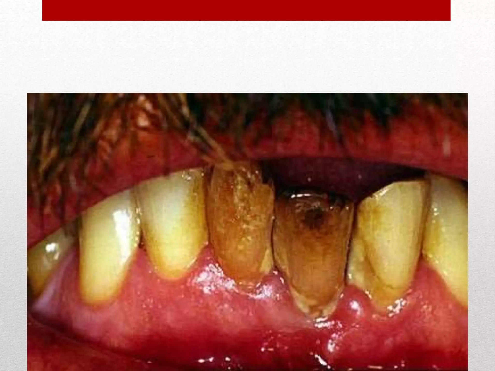 Deposits and stains of teeth | PPTX