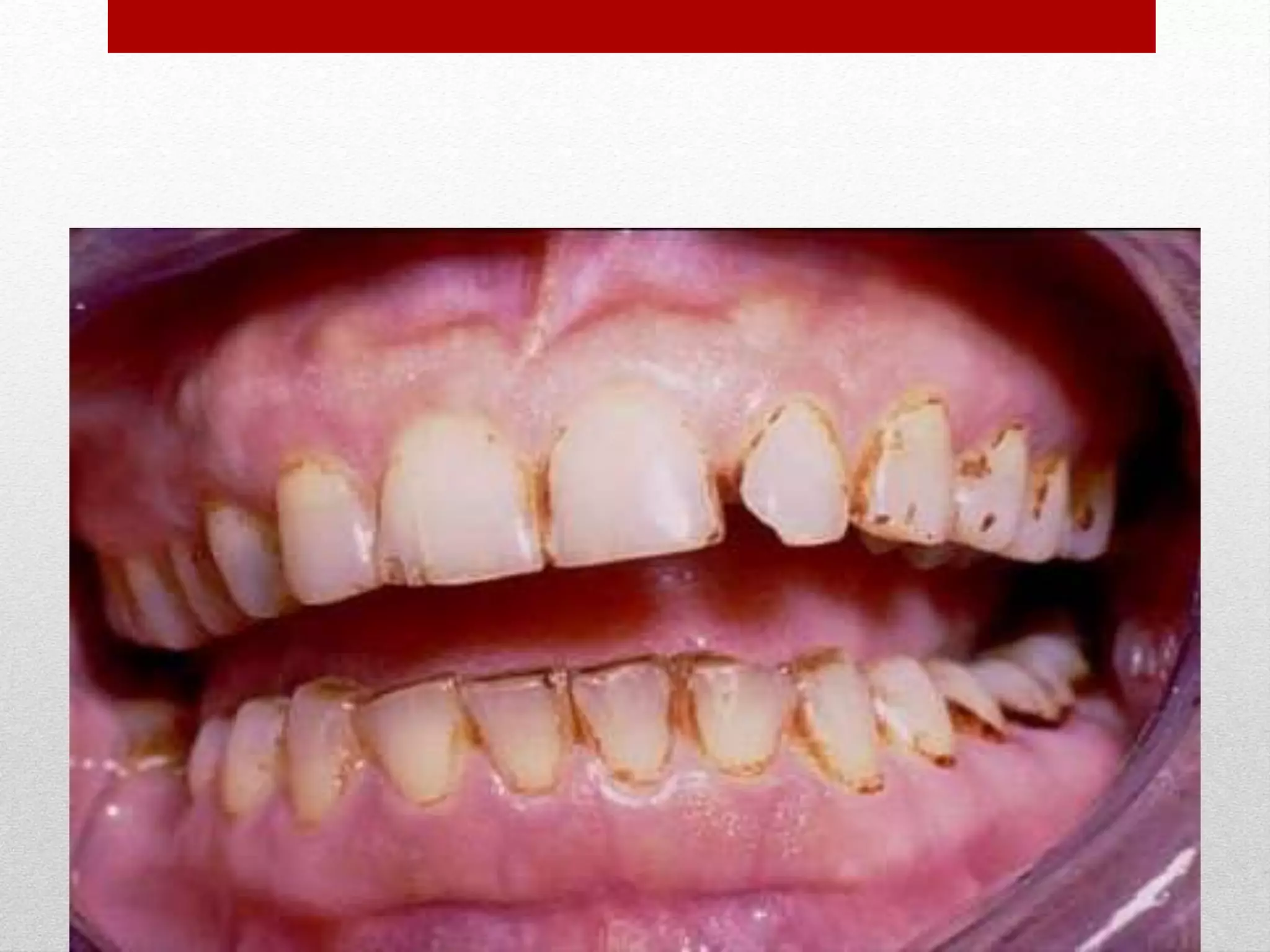 Deposits and stains of teeth | PPTX