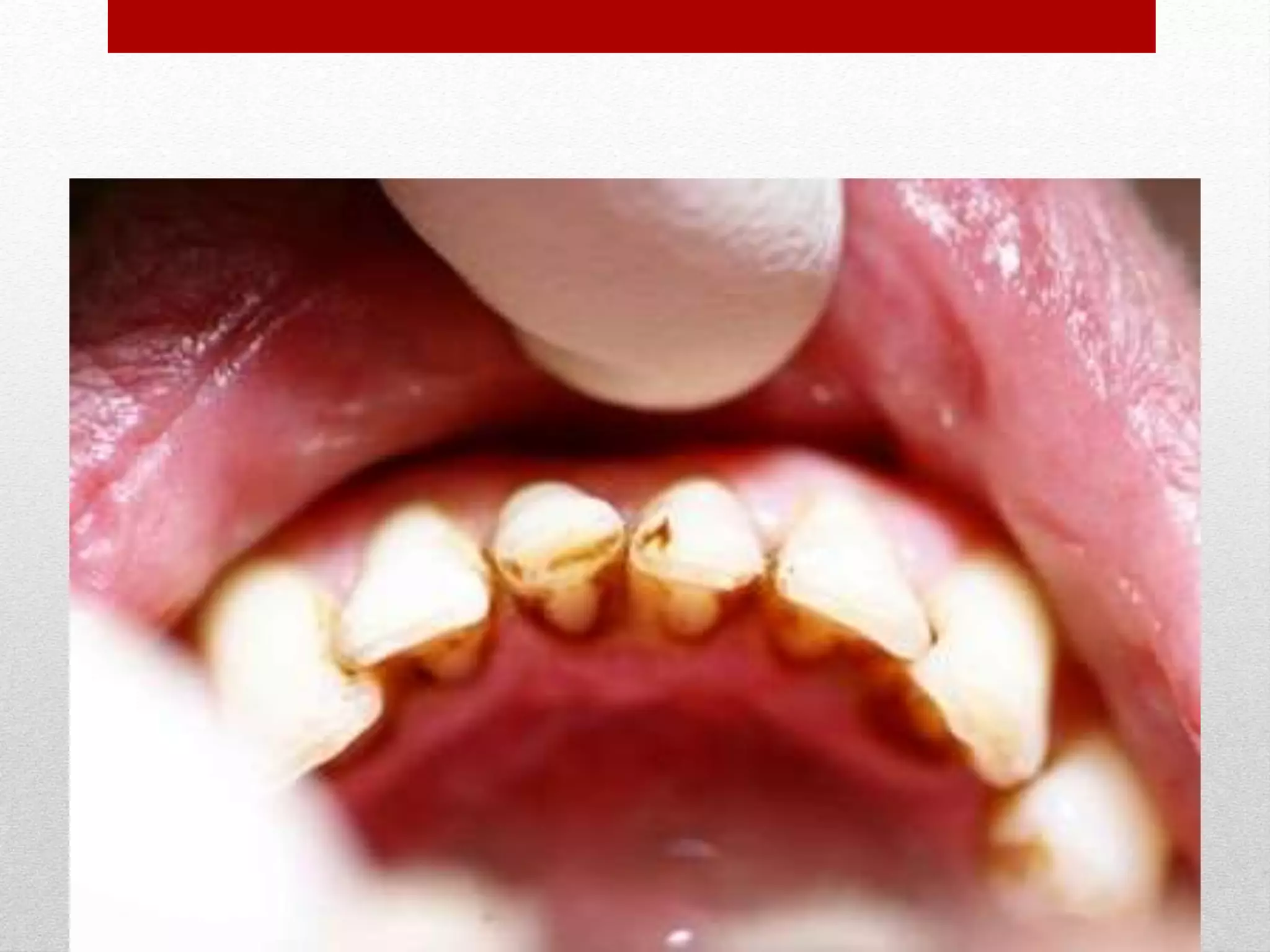 Deposits and stains of teeth | PPTX
